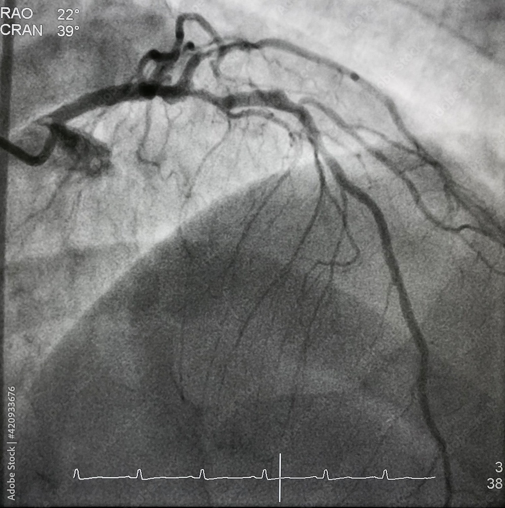 Coronary angiogram shown left anterior descending artery (LAD) stenosis ...