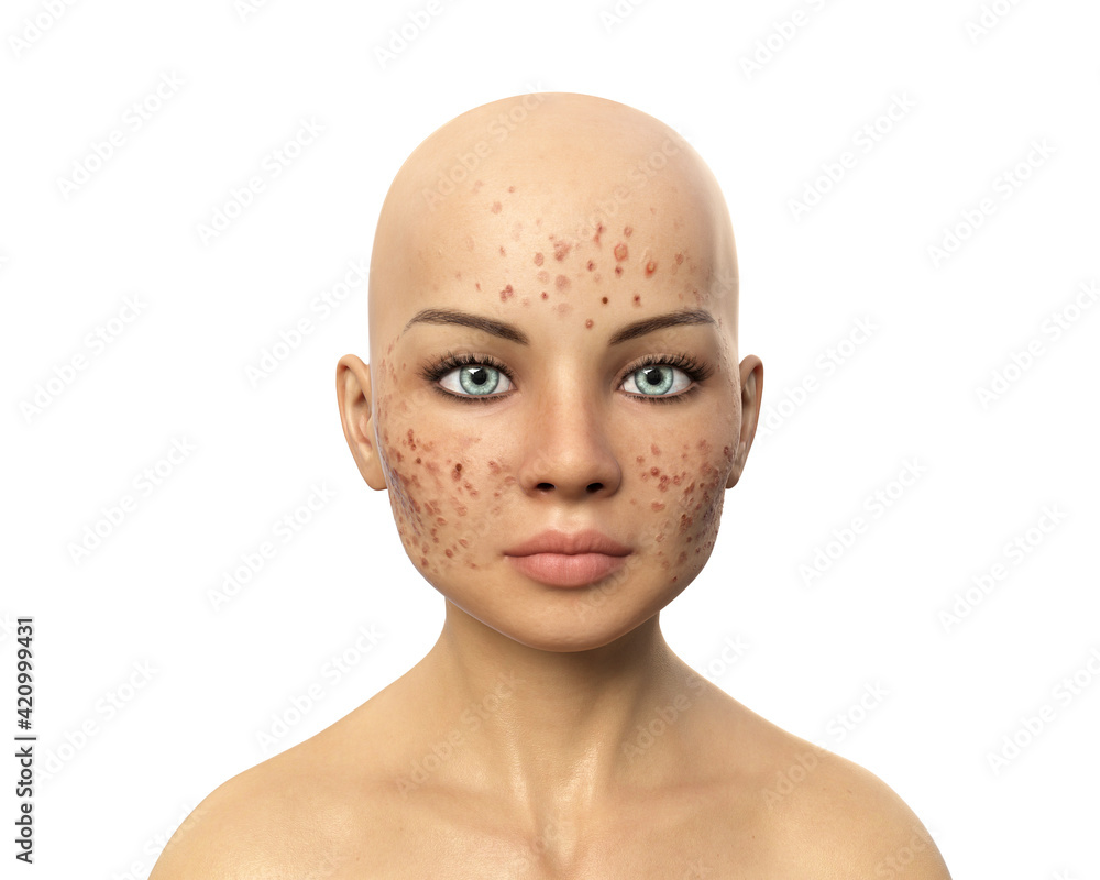 Acne vulgaris on skin, computer illustration Stock Illustration | Adobe ...