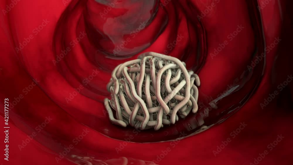 Parasitic worms in the lumen of the lumen, 3D animation. Growth and ...