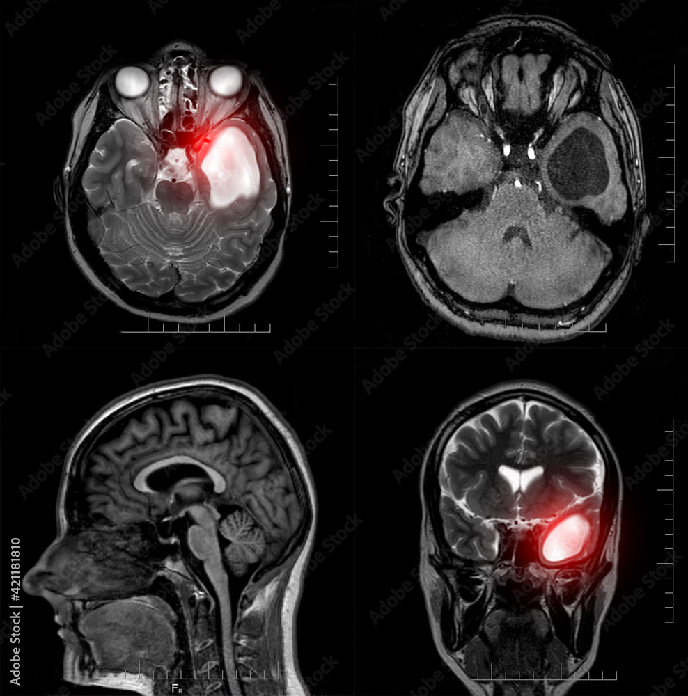 Magnetic resonance imaging of a patient with a temporal horn cyst of ...