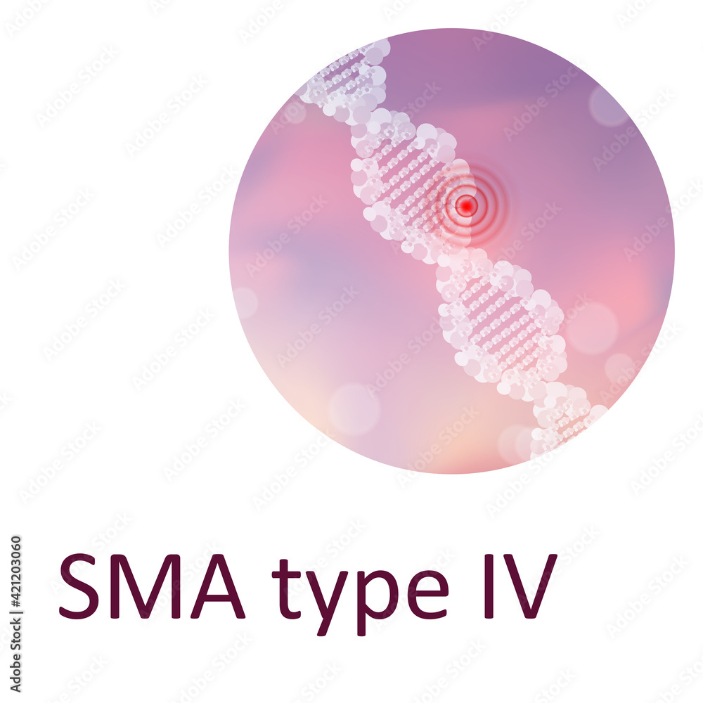 SMA type IV. Spinal muscular atrophy. Genetic. DNA double helix ...