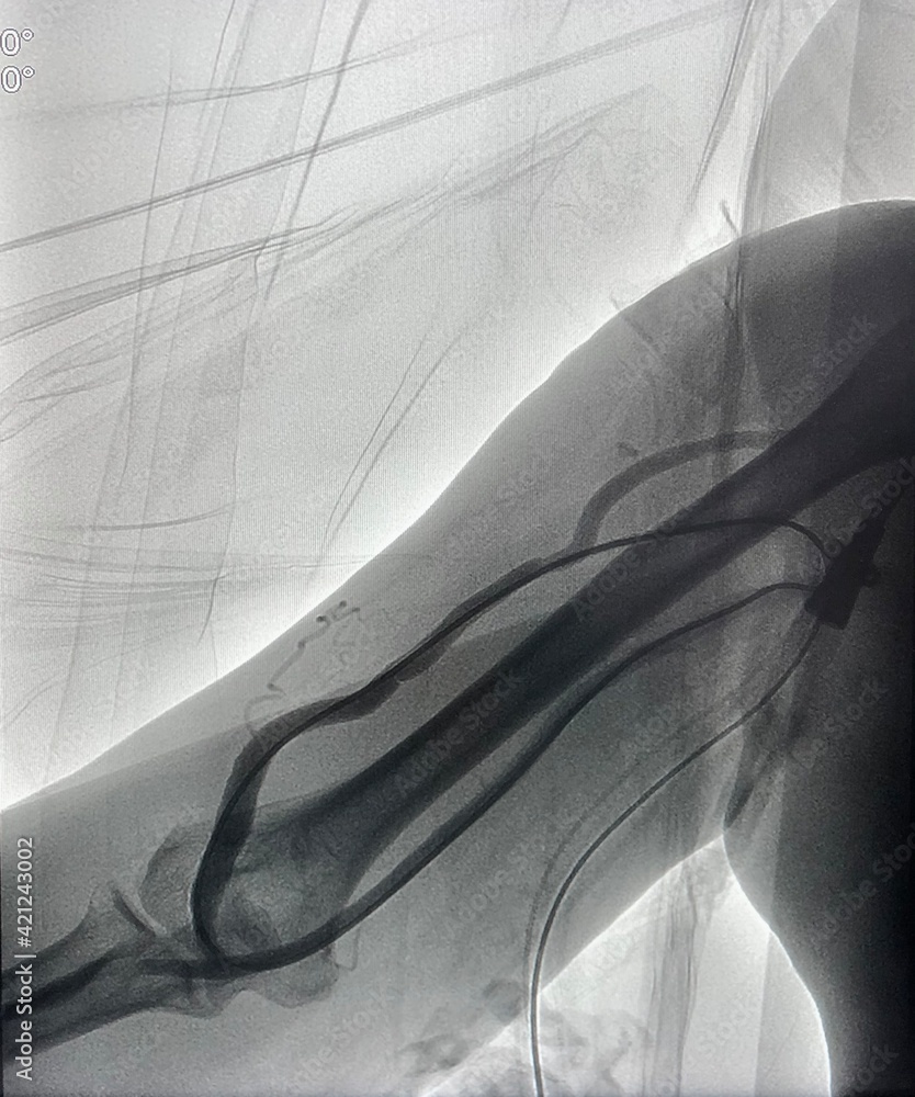 Angiogram of hemodialysis arteriovenous fistula (AVF) during ...