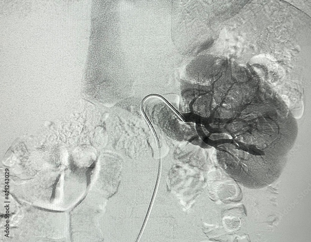 Angiogram shown renal artery rupture with bleeding around lesion Stock ...