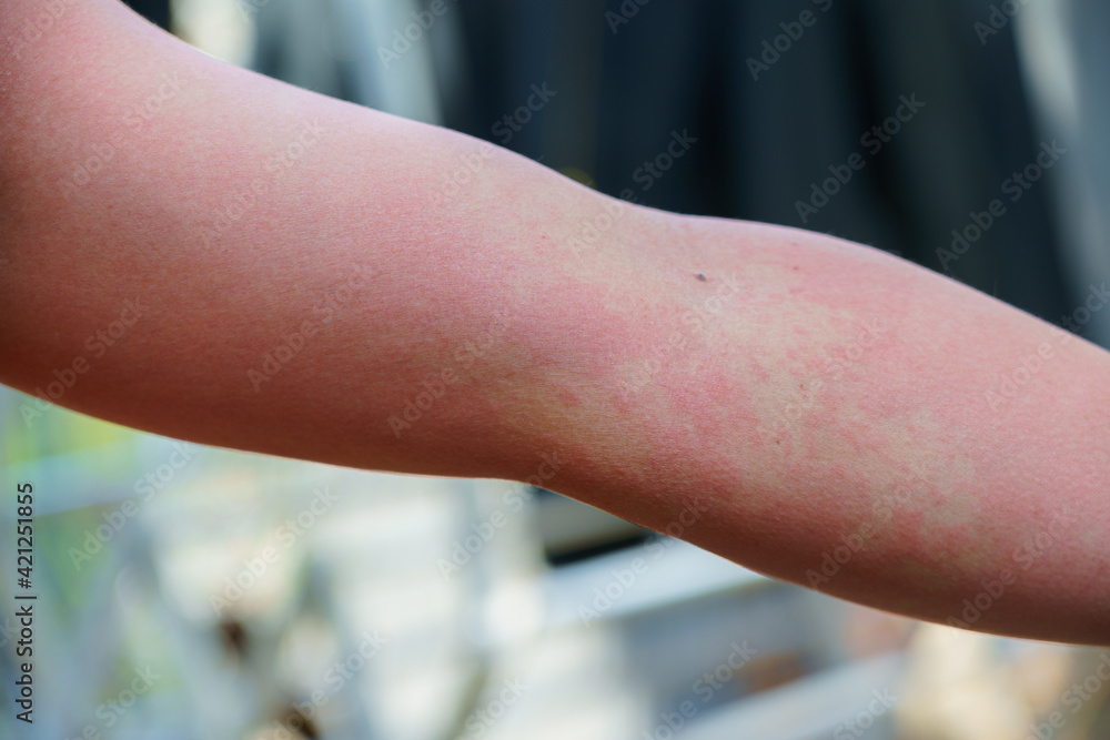 Man adult onset food allergy have had a severe reaction emergency care ...