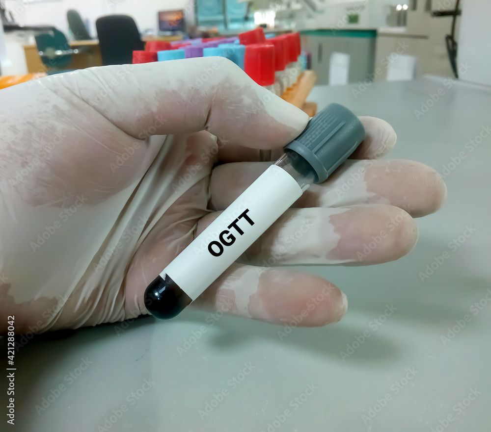 Technician or scientist hold a sample tube of Oral Glucose Tolerance ...