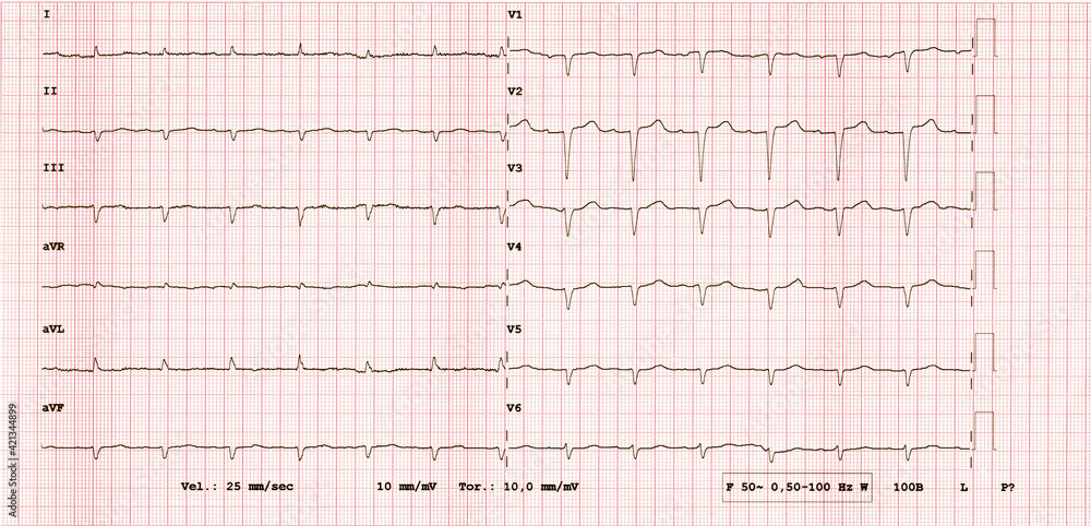 ECG 12-lead rhythm, example of rare pathology Amyloidosis Stock ...