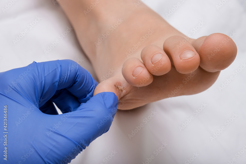A doctor examines a foot with dyshydrotic eczema, atopic dermatitis ...