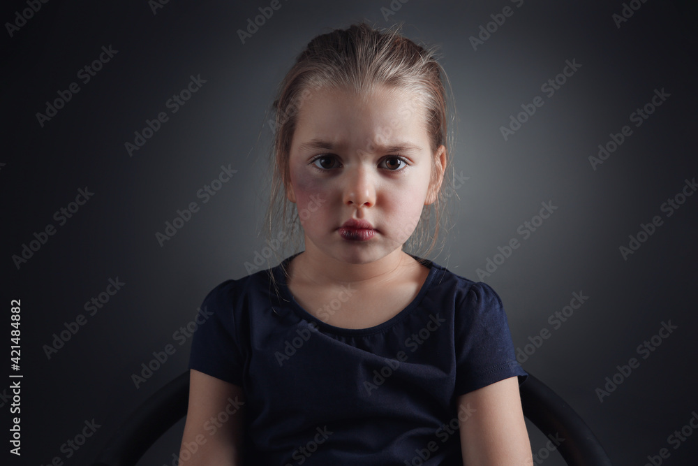Little girl with bruises on face against dark background. Domestic ...