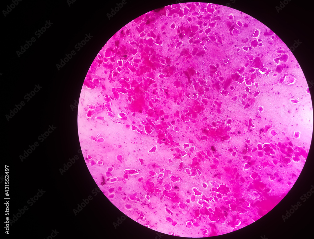 Microscopic view of Histology stained slide. closeup. cell carcinoma ...