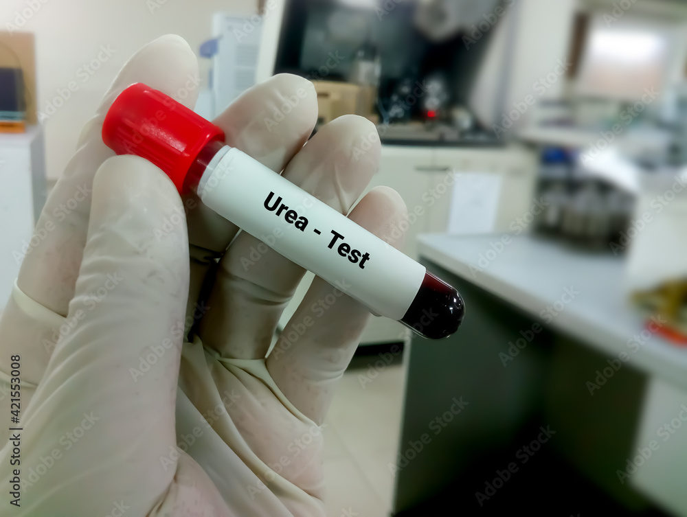 Blood sample for Renal Function Test. GFR, eGFR, Creatinine, Urea ...