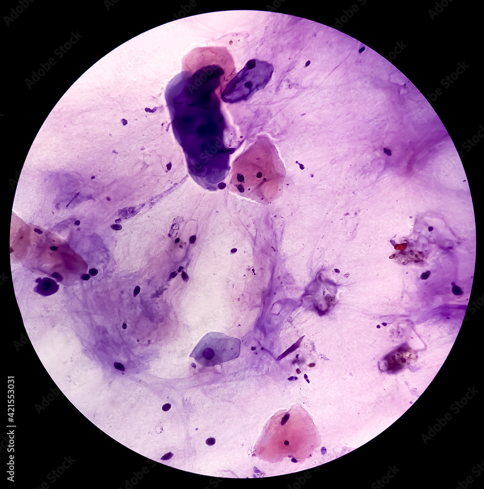 Microscopic view of Histology stained slide. closeup. cell carcinoma ...