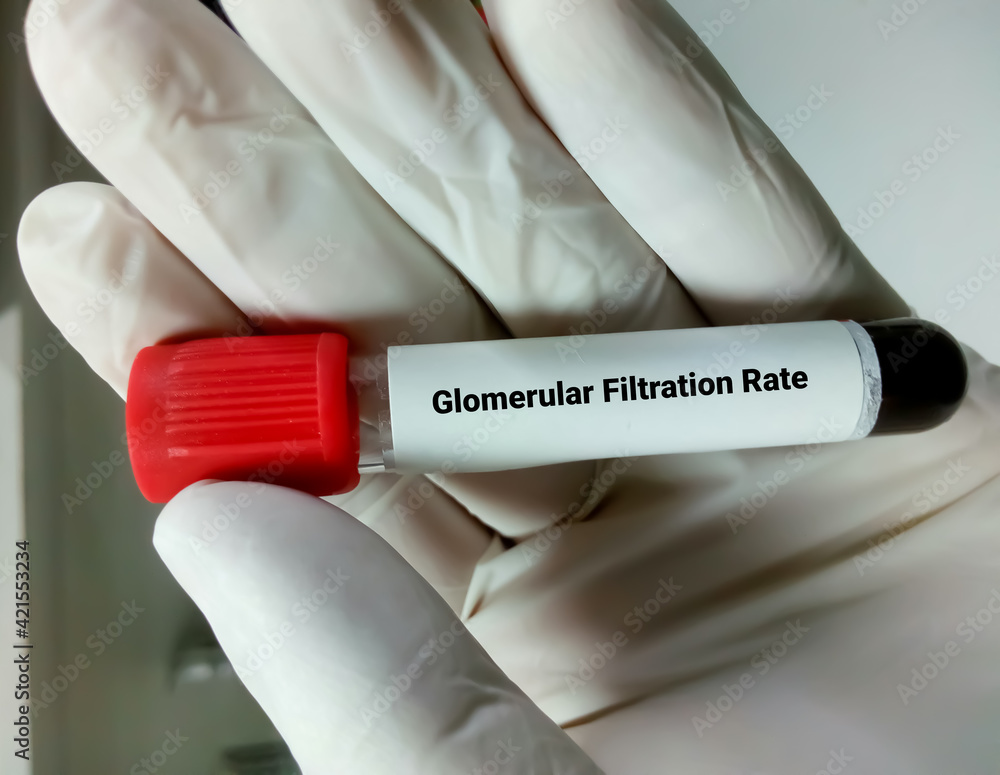 Blood sample for Renal Function Test. GFR, eGFR, Creatinine, Bun ...