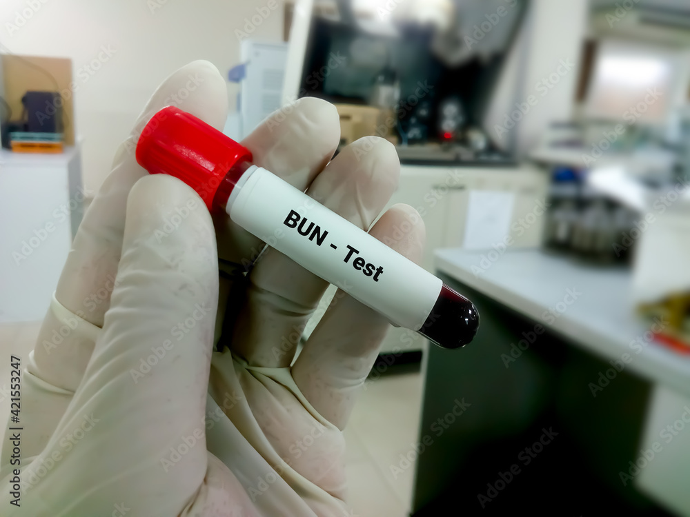 Blood sample for Bun test. Renal Function Test. Closeup. Stock Photo ...