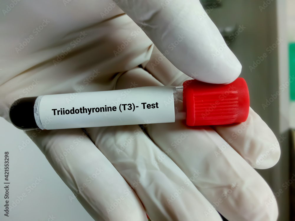 Blood sample in test tubes for hormonal examination of thyroid gland in ...