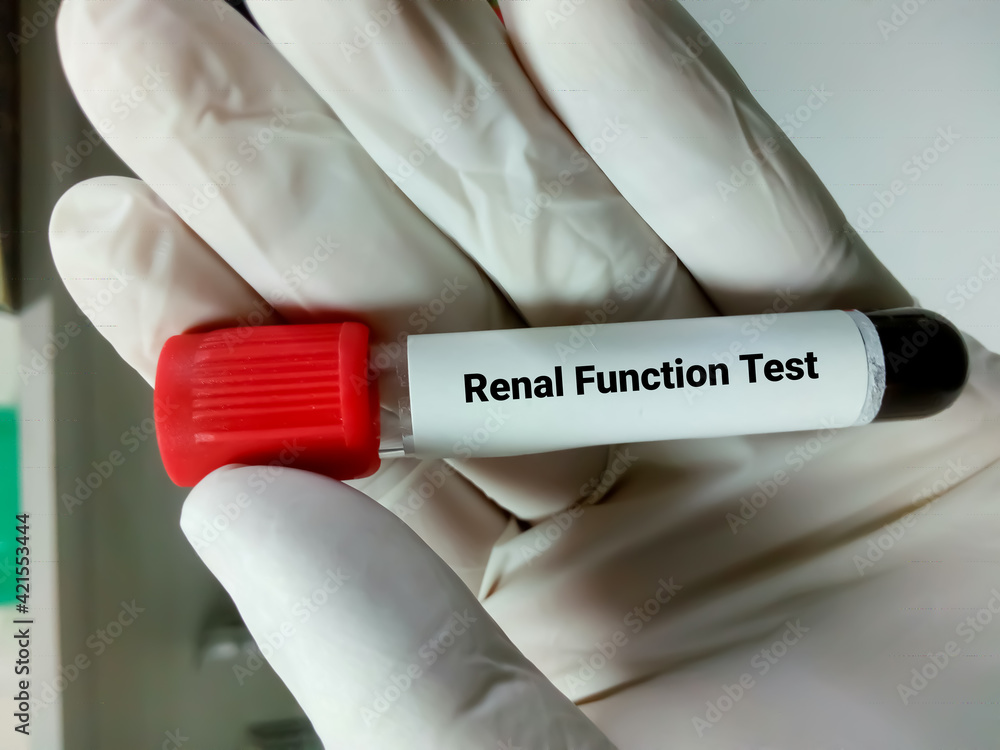 Blood sample for Renal Function Test. GFR, eGFR, Creatinine, Bun ...