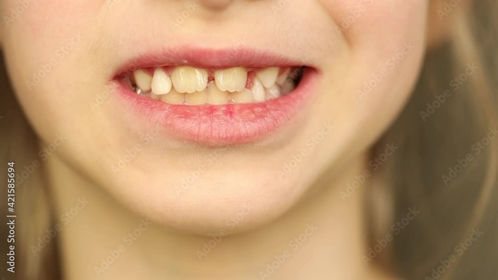 Unrecognizable girl touching loose tooth, close-up, lower part of face ...