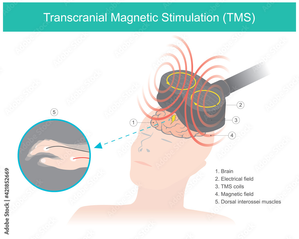 Transcranial Magnetic Stimulation (TMS). The brain stimulation in which a changing magnetic ...
