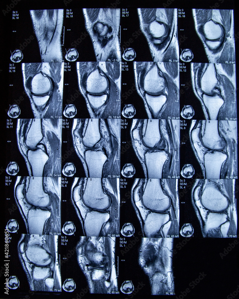 Magnetresonanztomographie / MRT von einem Knie / Kniegelenk. Stock ...