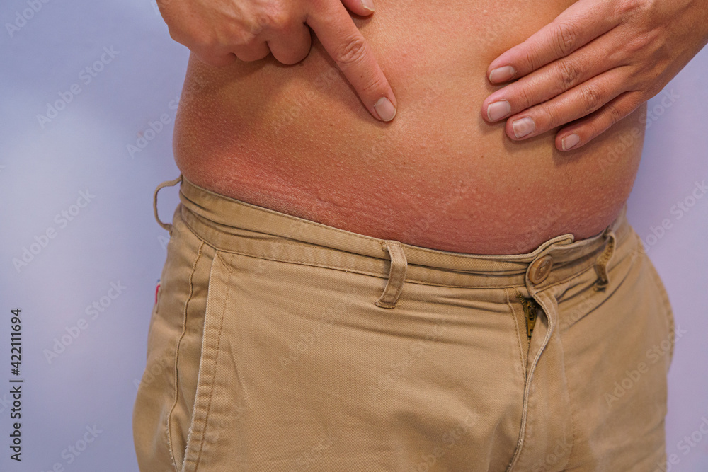 Man adult onset food allergy have had a severe reaction emergency care ...