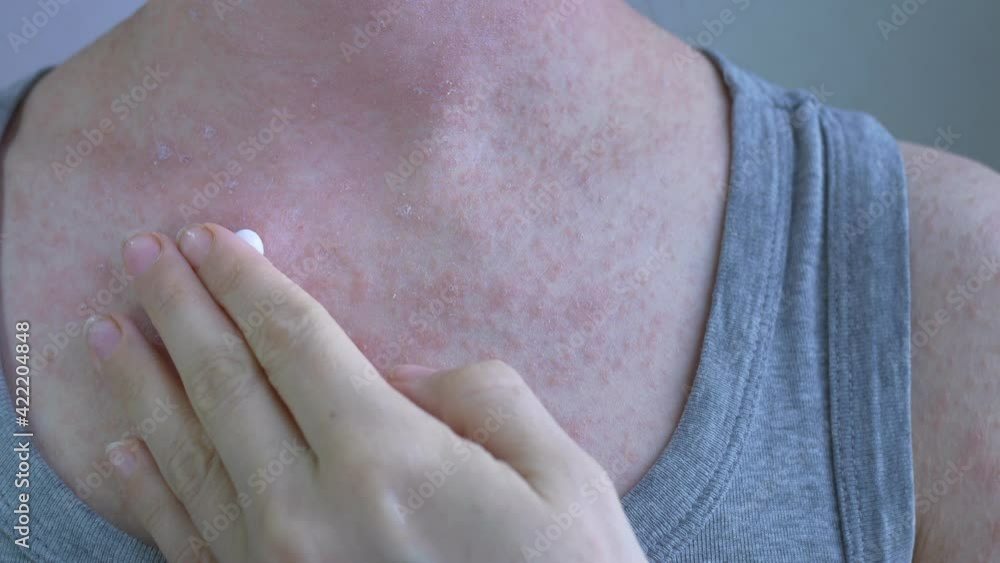 Close-up shows the affected skin areas with light red pimples. There is ...