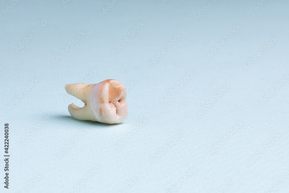 Pulled out wisdom tooth with filling and caries on blue background ...