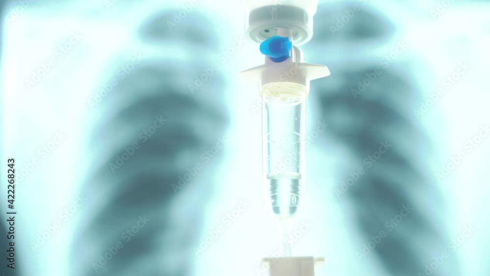 Saline drip medical, IV Drip Solution, Intravenous Treatment for ...