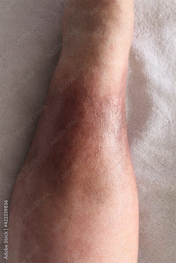 Top view of a woman's leg is shown, suffering from Chronic Venous ...