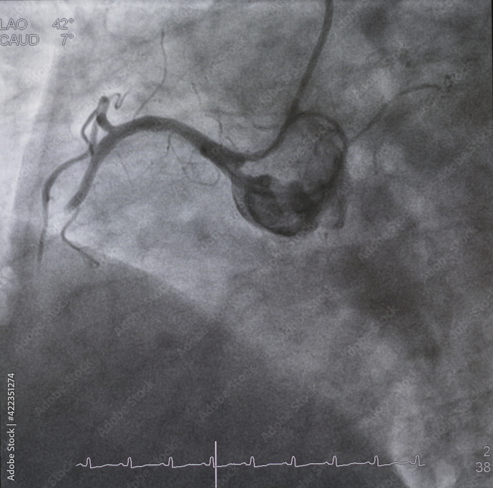 Coronary angiogram (CAG) was performed total occlusion at right ...
