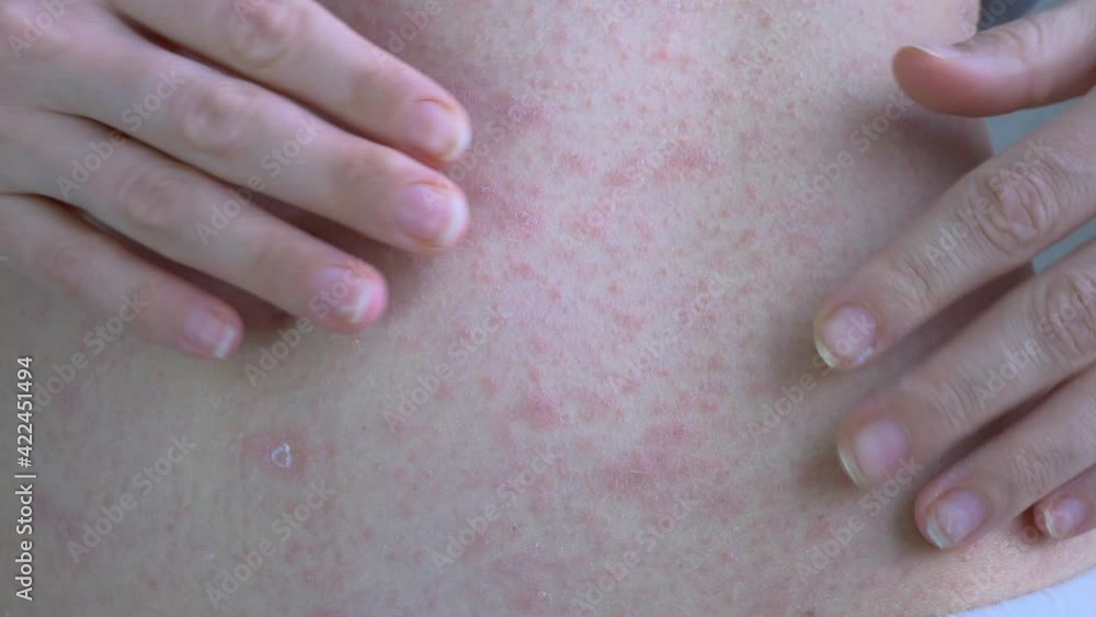 Hands show the affected areas of the skin on the abdominal cavity. On ...