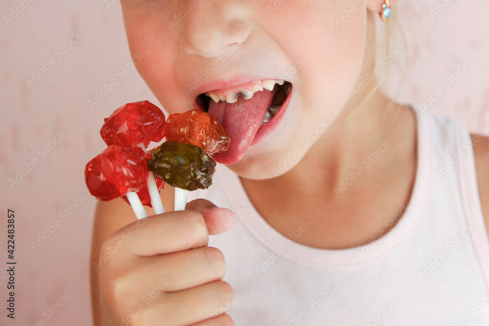 Child eats candy. Girl has caries on teeth. Stock Photo | Adobe Stock