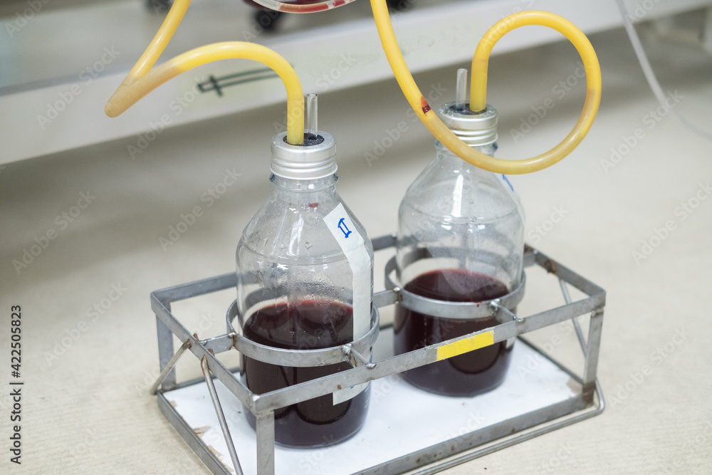 Two bottle system of chest drainage for patient post open heart surgery ...