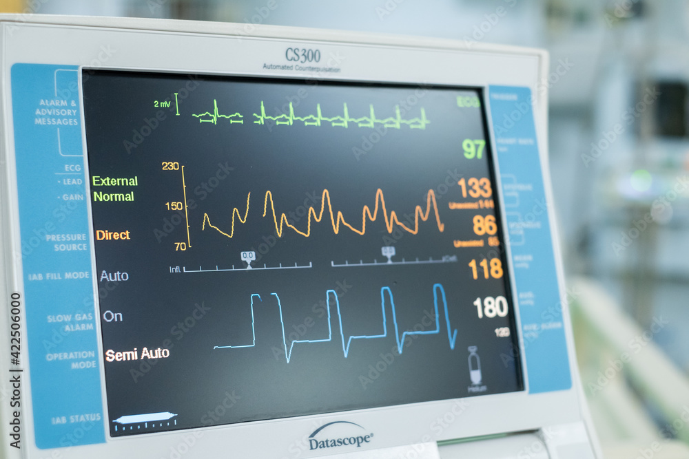EKG monitor in intra aortic balloon pump machine. Medical equipment in ...