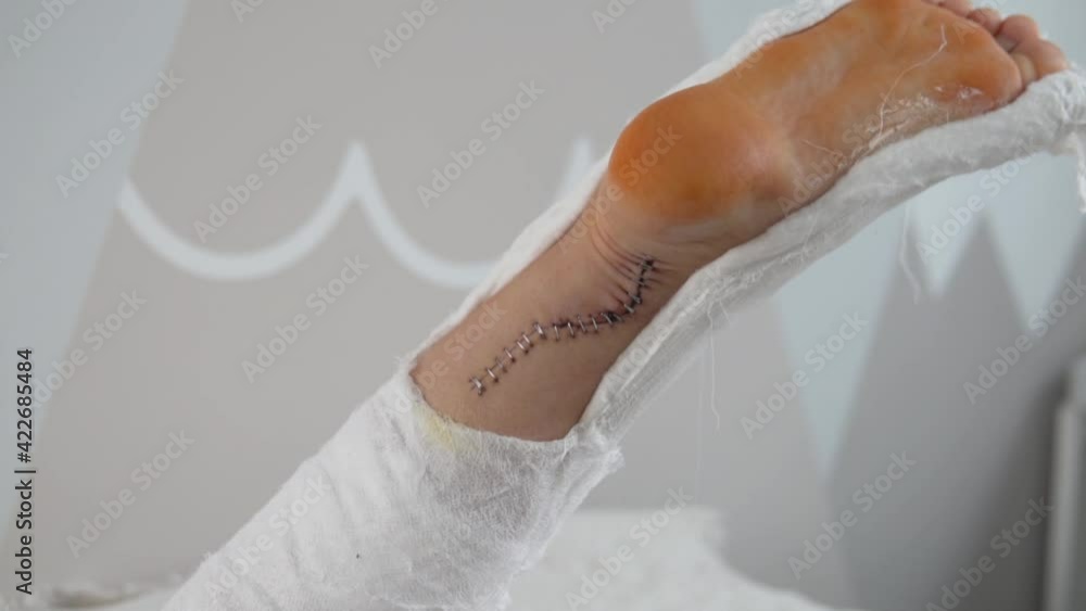 Close-up of the leg after surgery to stitch up the Achilles tendon ...