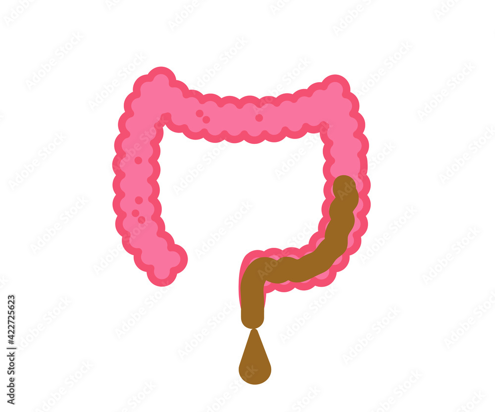 Large intestine on a white background. Diarrhea. Vector illustration ...