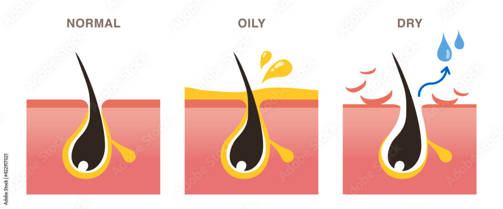 Skin cross section of pore types. Normal, oily, and dry pores. Pale ...