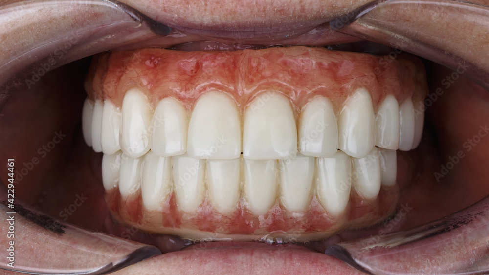temporary dentures of the upper and lower jaws in the patient's cavity ...