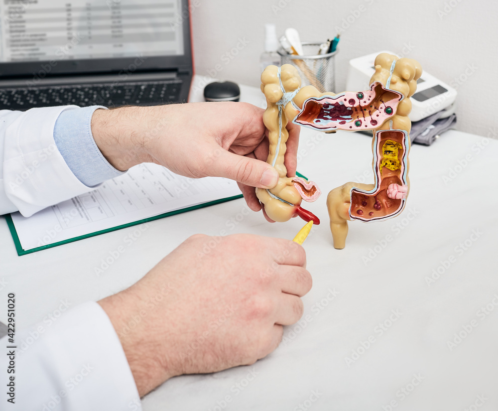 Doctor pointing pen to inflamed appendicitis using a intestines ...
