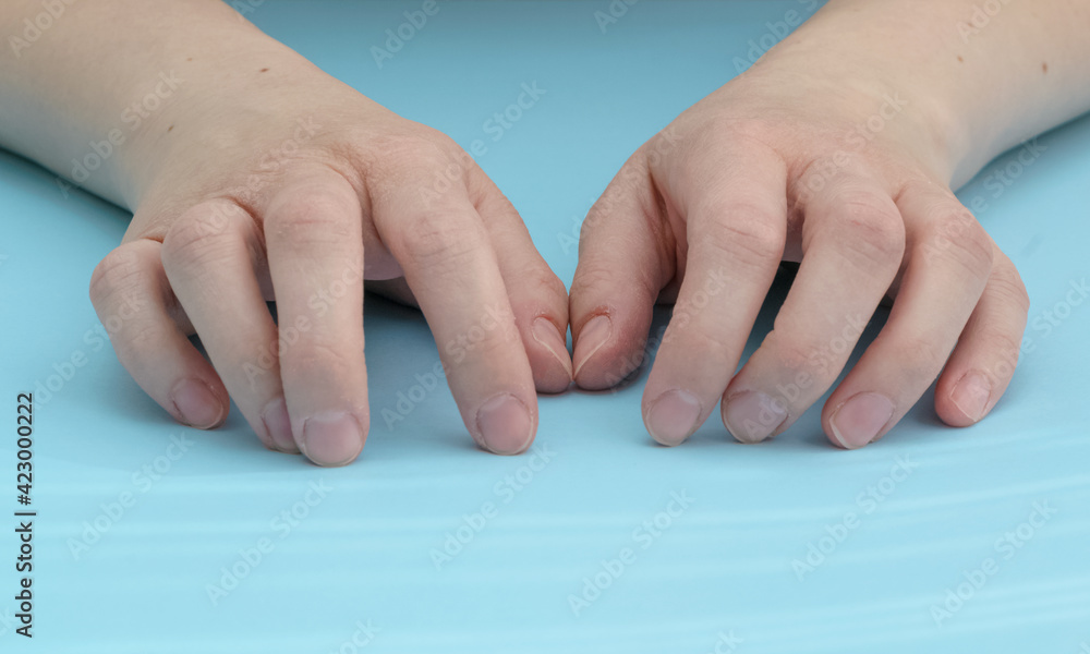 Broken finger.Arm injury after a fall.Injured middle finger of the left ...