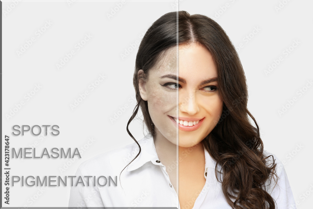 Dark spots, freckles,hyperpigmentation(melasma or chloasma),concept ...