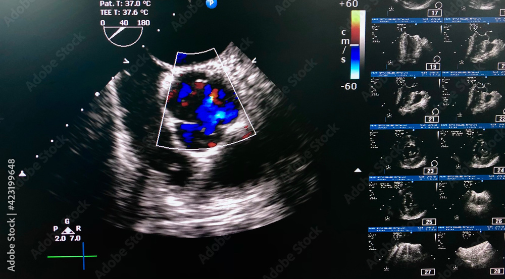Transesophageal echocardiogram (TEE) shown normal Aortic valve (AV ...