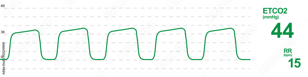 Capnography Monitor Equipment Screen. ETCO2, RR and capnogram Stock ...
