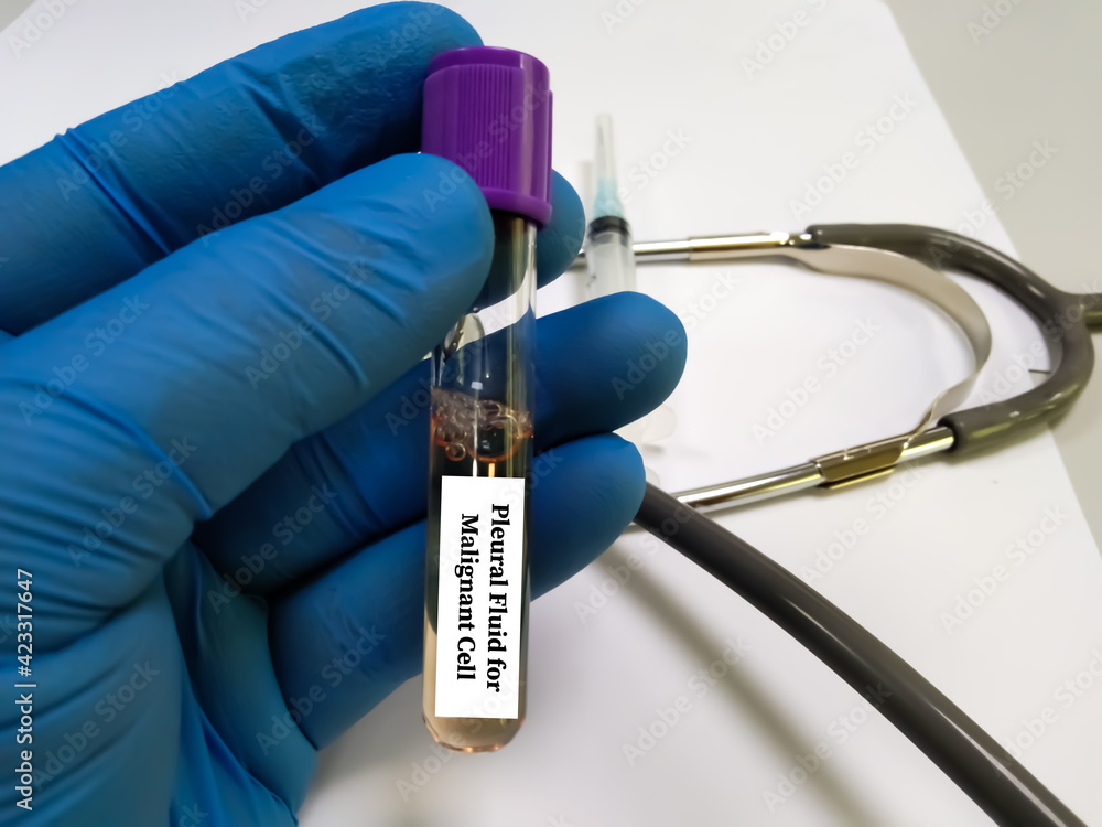 Biochemist hold a syringe with Pleural fluid sample, which is ready for ...