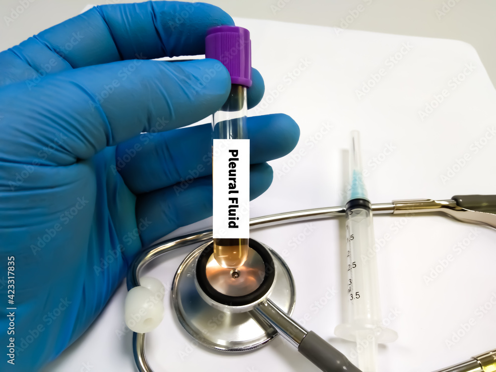 Pleural fluid sample with laboratory background, which is ready for ...