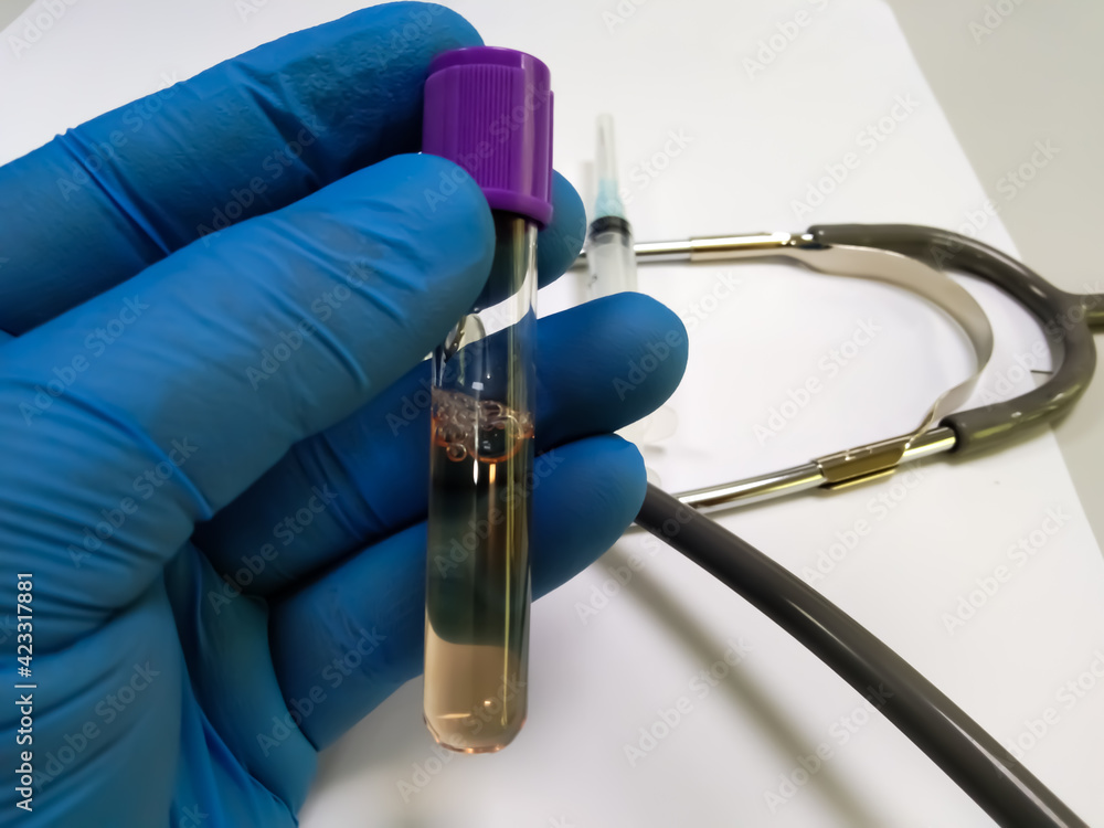 Pleural fluid sample with laboratory background, which is ready for ...