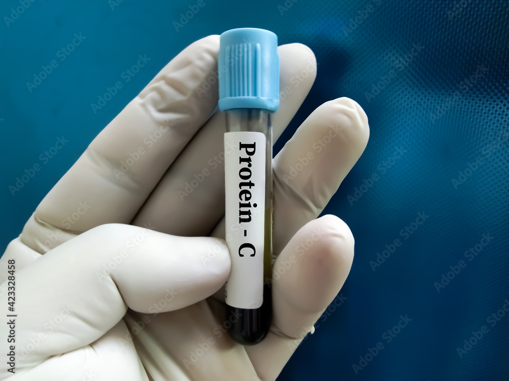 Test tube with blood sample for protein S and protein C test ...