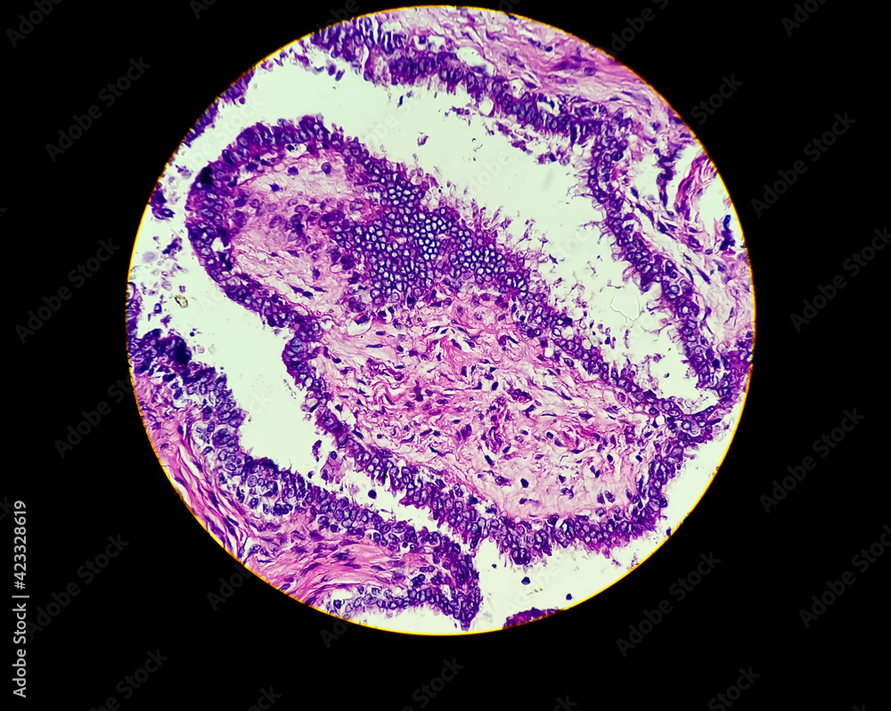 Breast tumor, or nephroblastoma, light micrograph, photo under ...