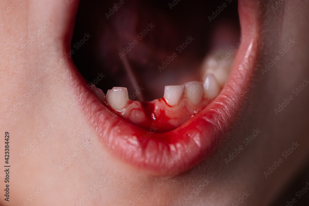 close-up bloody wound in the gum from the first temporary baby tooth ...
