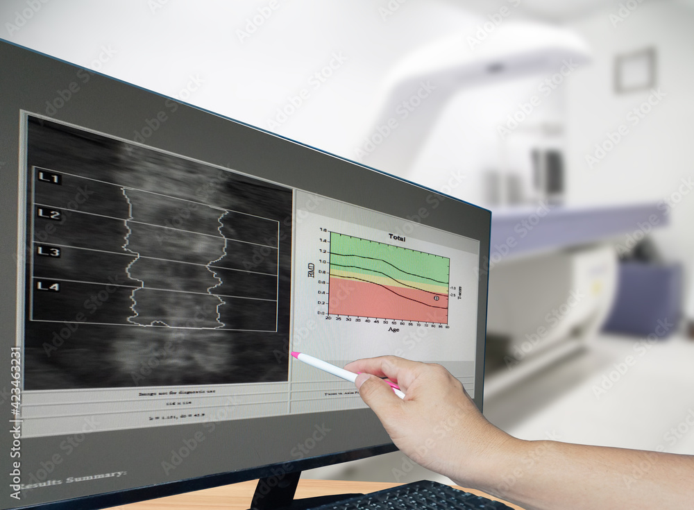 Close Up Hand Doctor Point Image Of Dxa Bone Density Scan On Moniter In