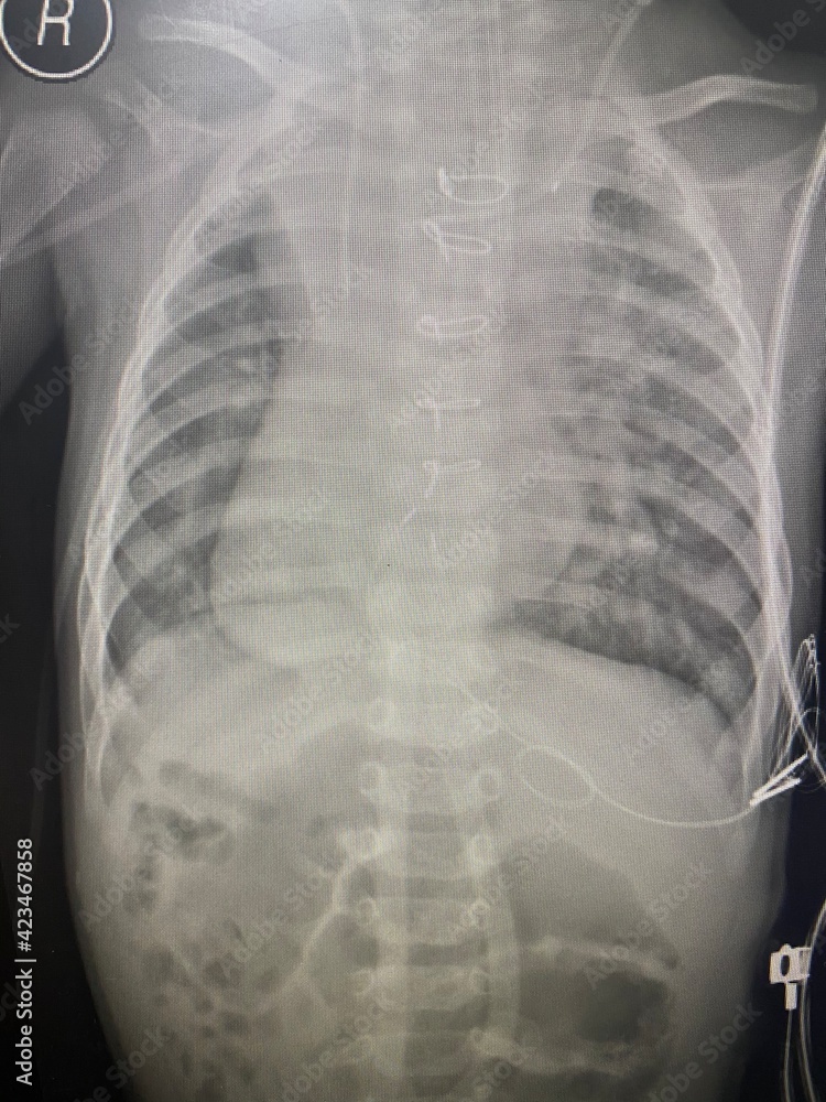 Film x-ray show situs inversus means all organs are inverted and ...