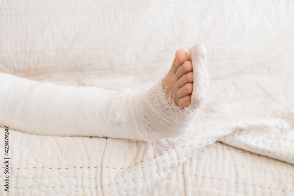 broken leg. Close-up of the cast on the feet. exercises to repair and ...
